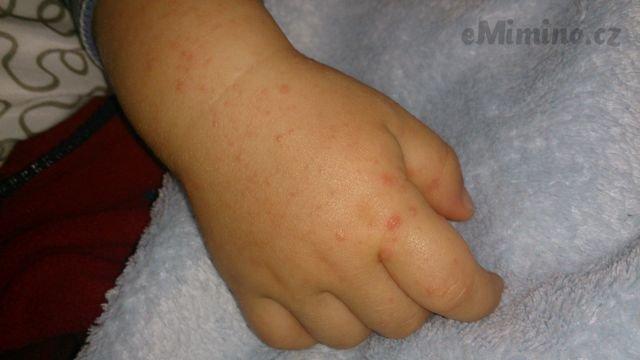 Spálová angína - kde všude vyrážka? - Diskuze - eMimino.cz
