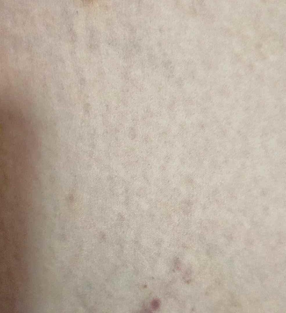 Fleky na kůži co vypadají jako modřiny - Diskuze - eMimino.cz