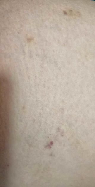 Fleky na kůži co vypadají jako modřiny - Diskuze - eMimino.cz