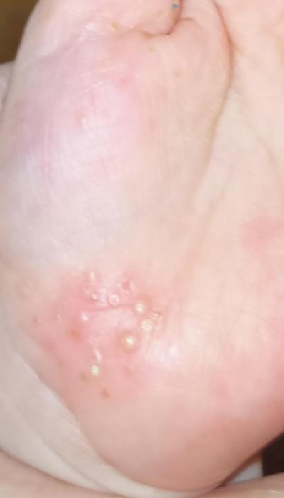 Atypický svrab - Diskuze - eMimino.cz