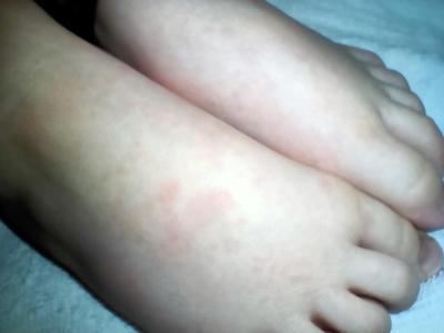 Atypický svrab - Diskuze - eMimino.cz