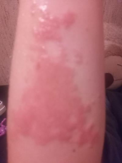 Vyrazka na rukou koprivka - Diskuze - eMimino.cz