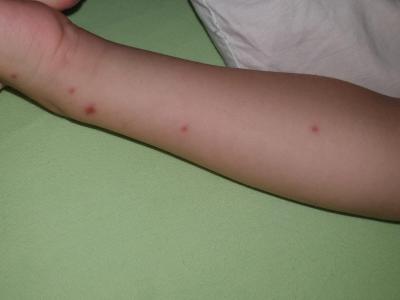 Za jak dlouho se objeví vyrážka u sedmé nemoci? (3) - Diskuze - eMimino.cz