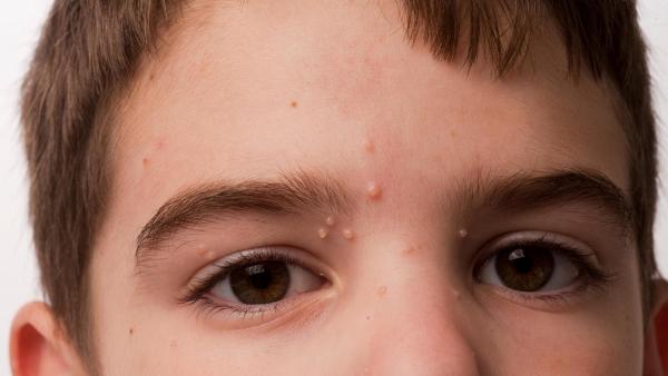 Molusky u dětí: Jak je poznat a léčit? - eMimino.cz