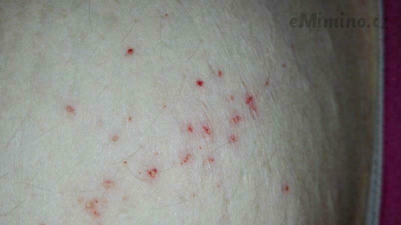 Petechie: Jak je poznat a co znamenají? - eMimino.cz
