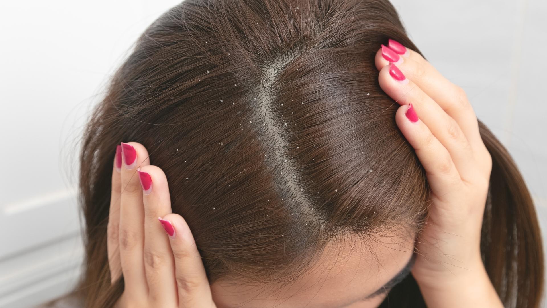 Seborea, jak ji poznat a vyléčit? - eMimino.cz