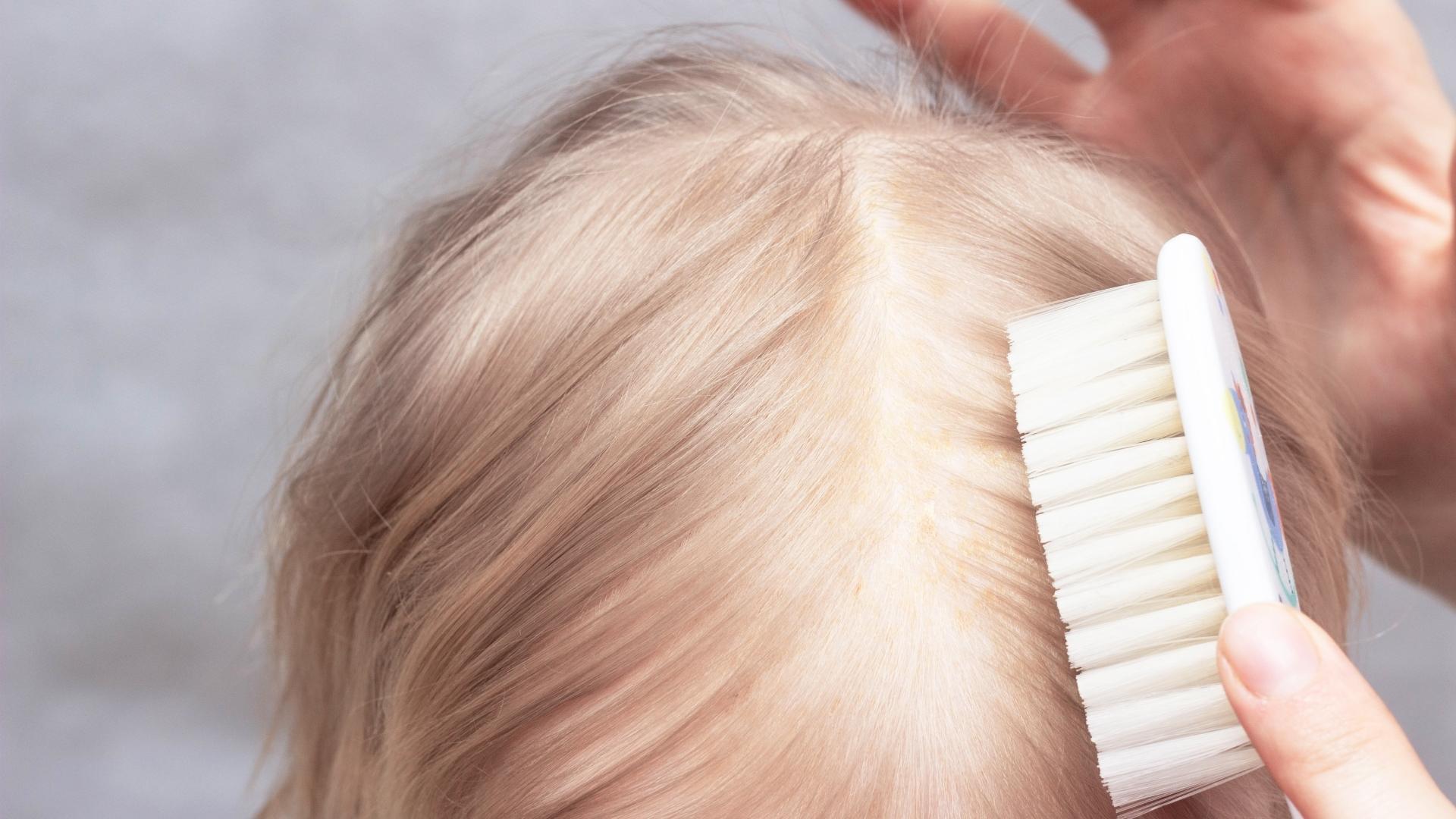 Seborea, jak ji poznat a vyléčit? - eMimino.cz