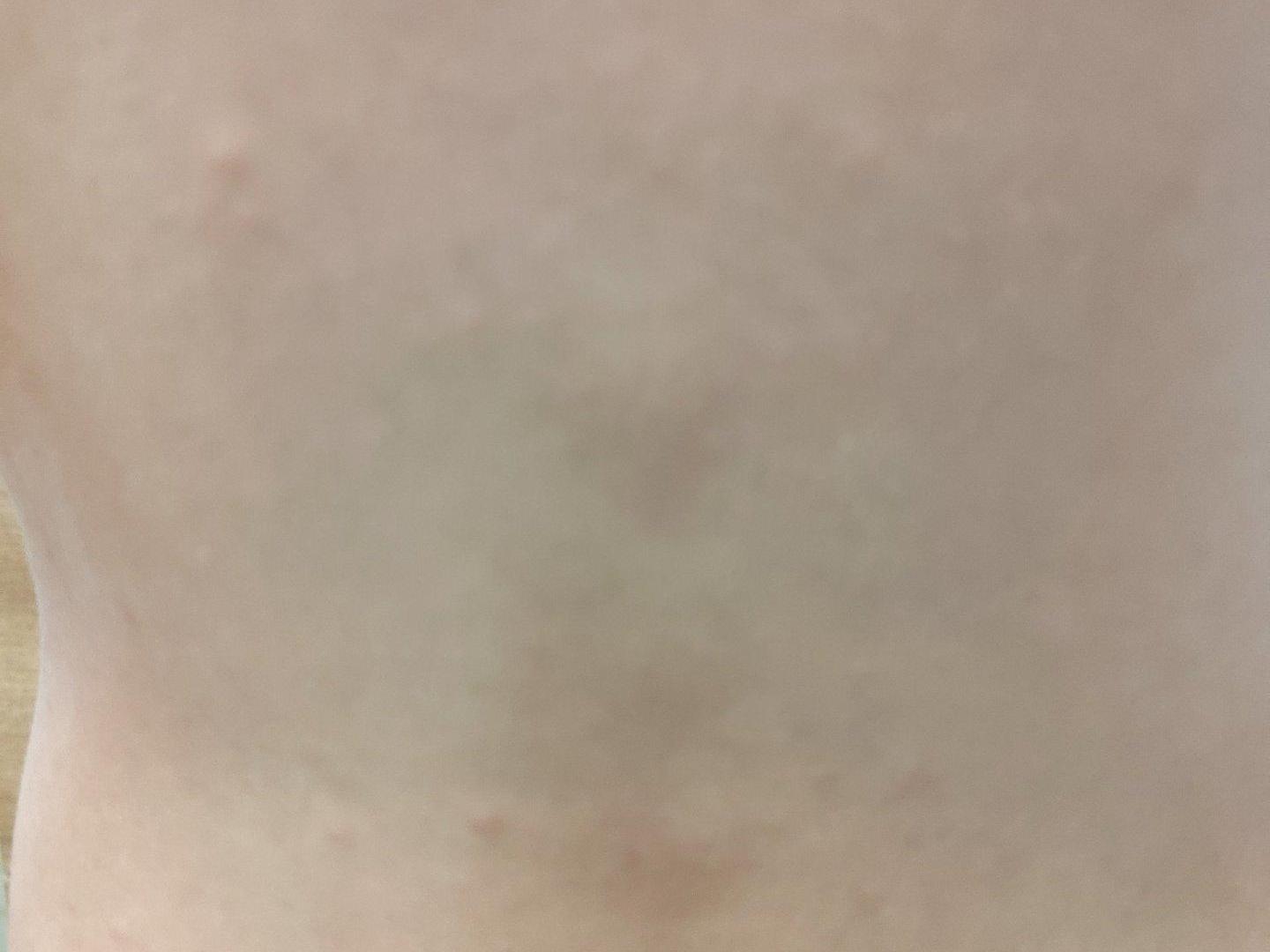 Svrab - jak se zbavit? - Diskuze - eMimino.cz