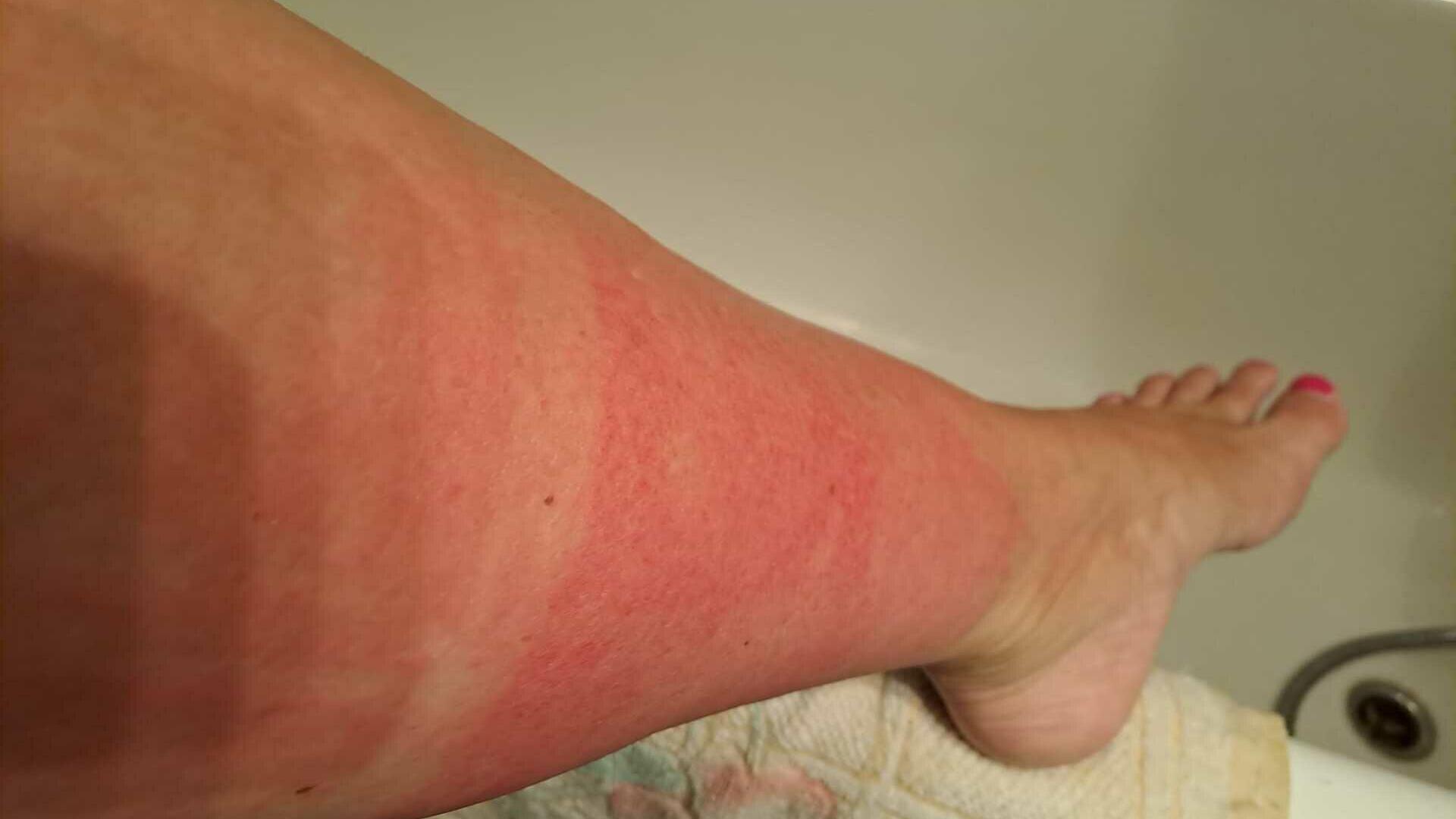 Červené fleky na lýtku - Diskuze - eMimino.cz