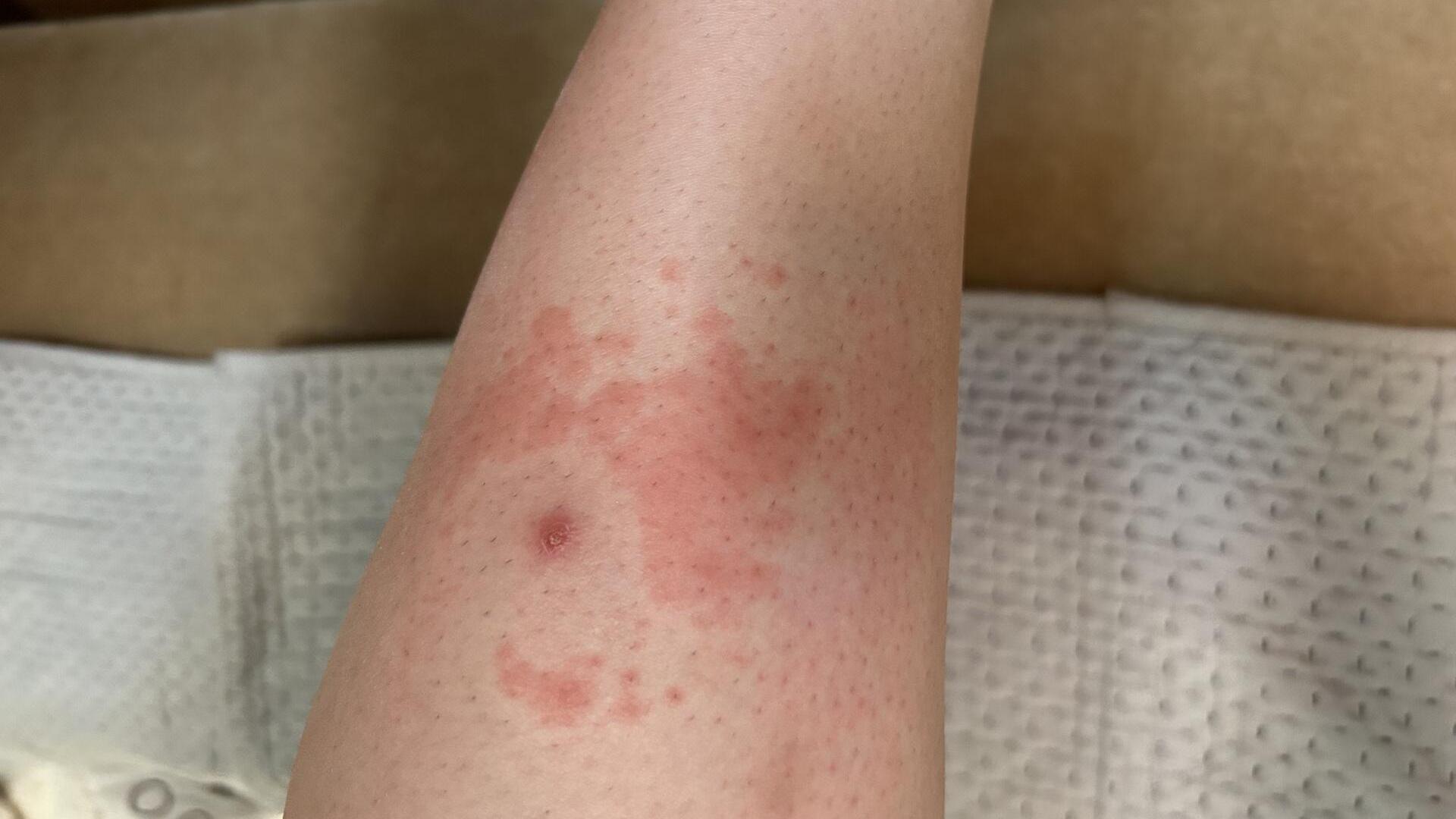 Borelióza - flek a antibiotika - Diskuze - eMimino.cz