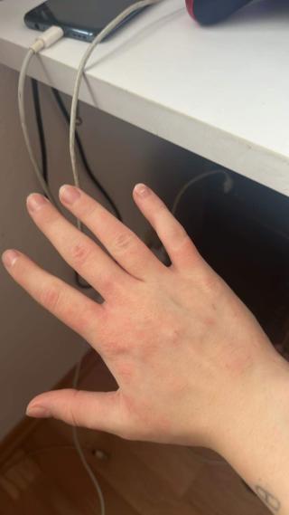 Ekzém na rukách - Diskuze - eMimino.cz