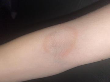 Borelióza příznaky a flek? - Diskuze - eMimino.cz