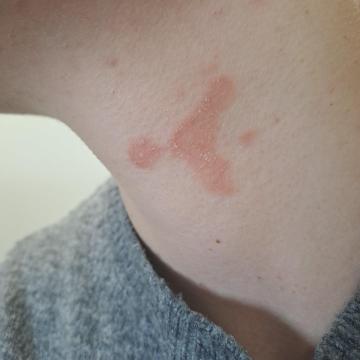 Červené fleky na krku - Diskuze - eMimino.cz