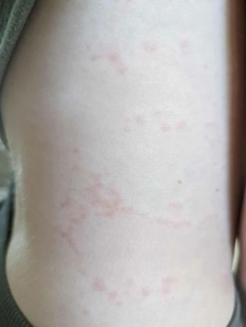 Fleky na kůži - alergie nebo mám plašit ? - Diskuze - eMimino.cz