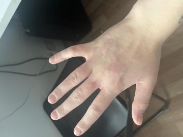 Ekzém na rukách - Diskuze - eMimino.cz