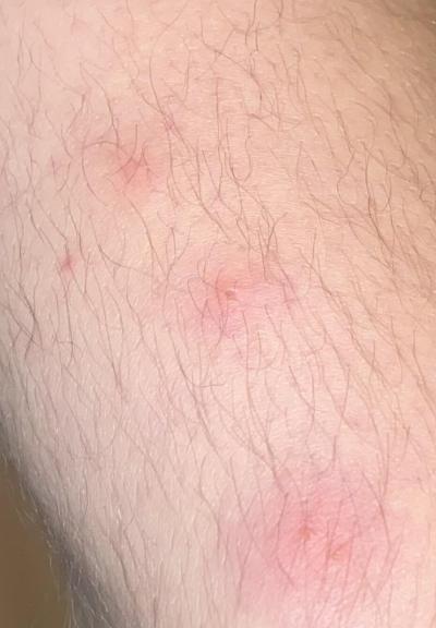 Kousnutí od štěnice? Jak postupovat - Diskuze - eMimino.cz