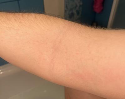 Jedná se o svrab? - Diskuze - eMimino.cz