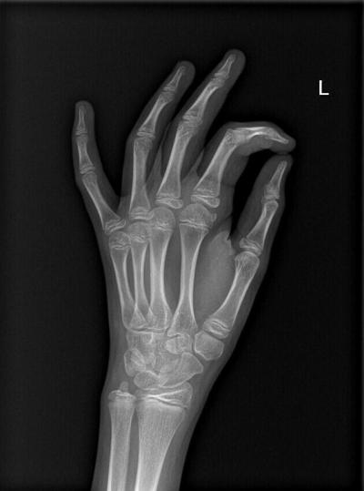 RTG zlomenina - nějaký diagnostik ze zobrazovacích metod? - Diskuze ...