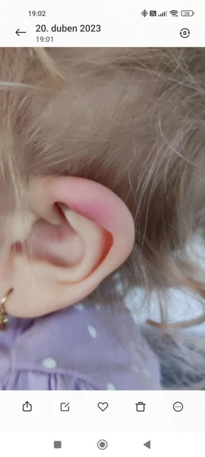 Je to borelióza? Jít zítra k lékaři? - Diskuze - eMimino.cz