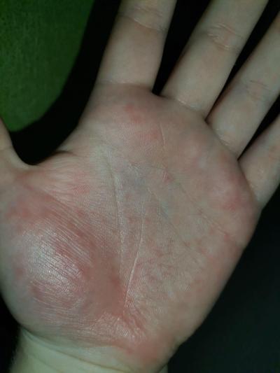 Svědivé pupínky na rukou - Diskuze - eMimino.cz