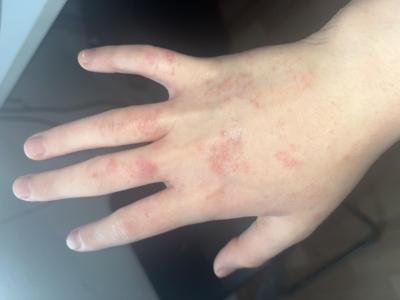 Ekzém na rukách - Diskuze - eMimino.cz