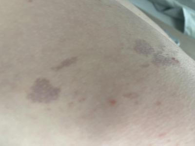 Fialovo-hnědé fleky na zádech - Diskuze - eMimino.cz