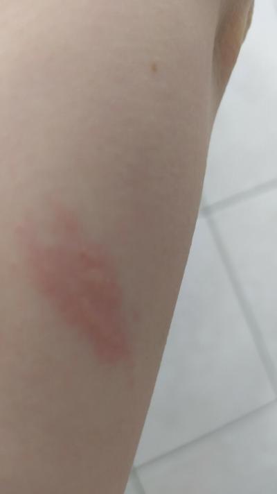 Je to svrab nebo něco jiného? - Diskuze - eMimino.cz