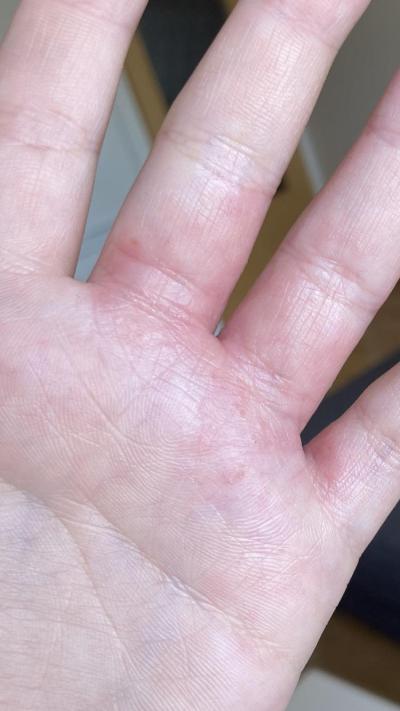 Ekzematici? Je to zase atopický ekzém? - Diskuze - eMimino.cz