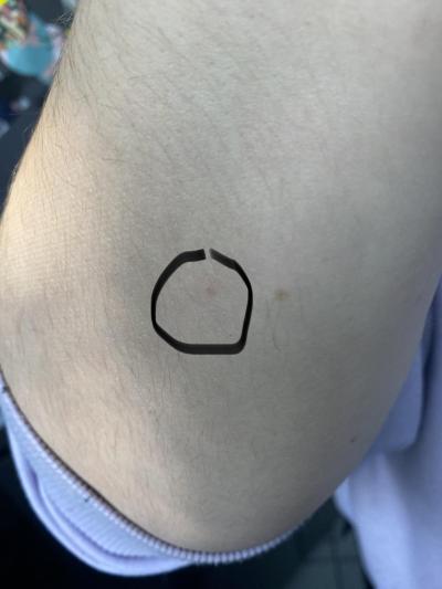 Svrab - noční svědění, svedive pupinky - Diskuze - eMimino.cz