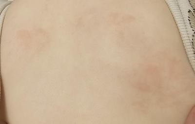 Červené fleky po koupeli - Diskuze - eMimino.cz