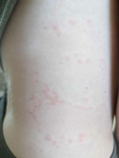Fleky na kůži - alergie nebo mám plašit ? - Diskuze - eMimino.cz