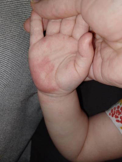 7.nemoc či svrab? - Poradna - eMimino.cz