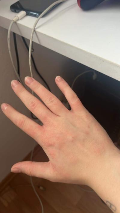 Ekzém na rukách - Diskuze - eMimino.cz