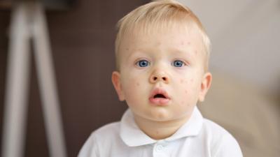 Petechie: Jak je poznat a co znamenají? - eMimino.cz