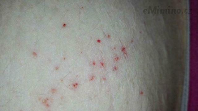 Petechie: Jak je poznat a co znamenají? - eMimino.cz