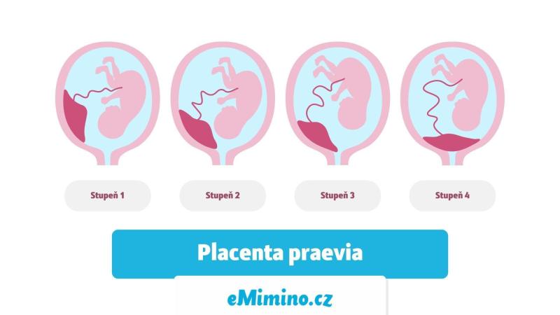 Placenta praevia, když se placenta nachází nízko - eMimino.cz