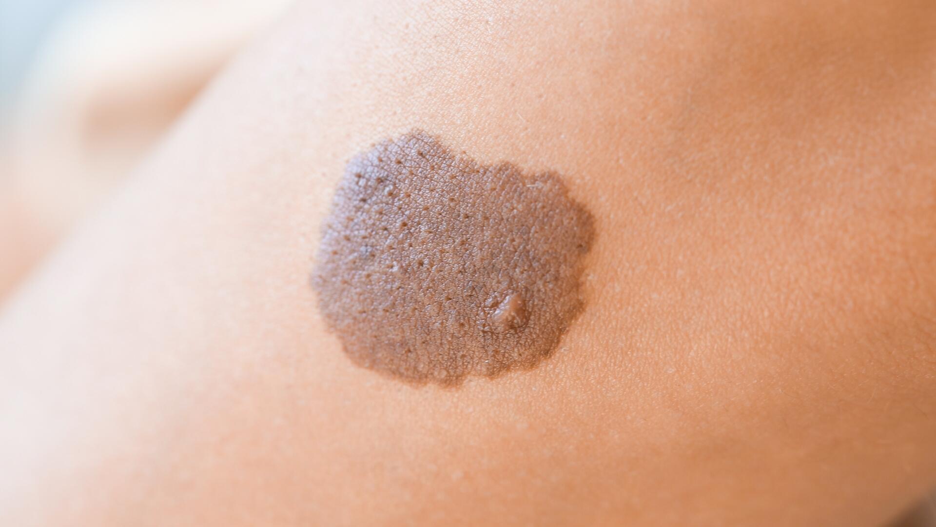 Jak poznat, že mám rakovinu kůže? - eMimino.cz