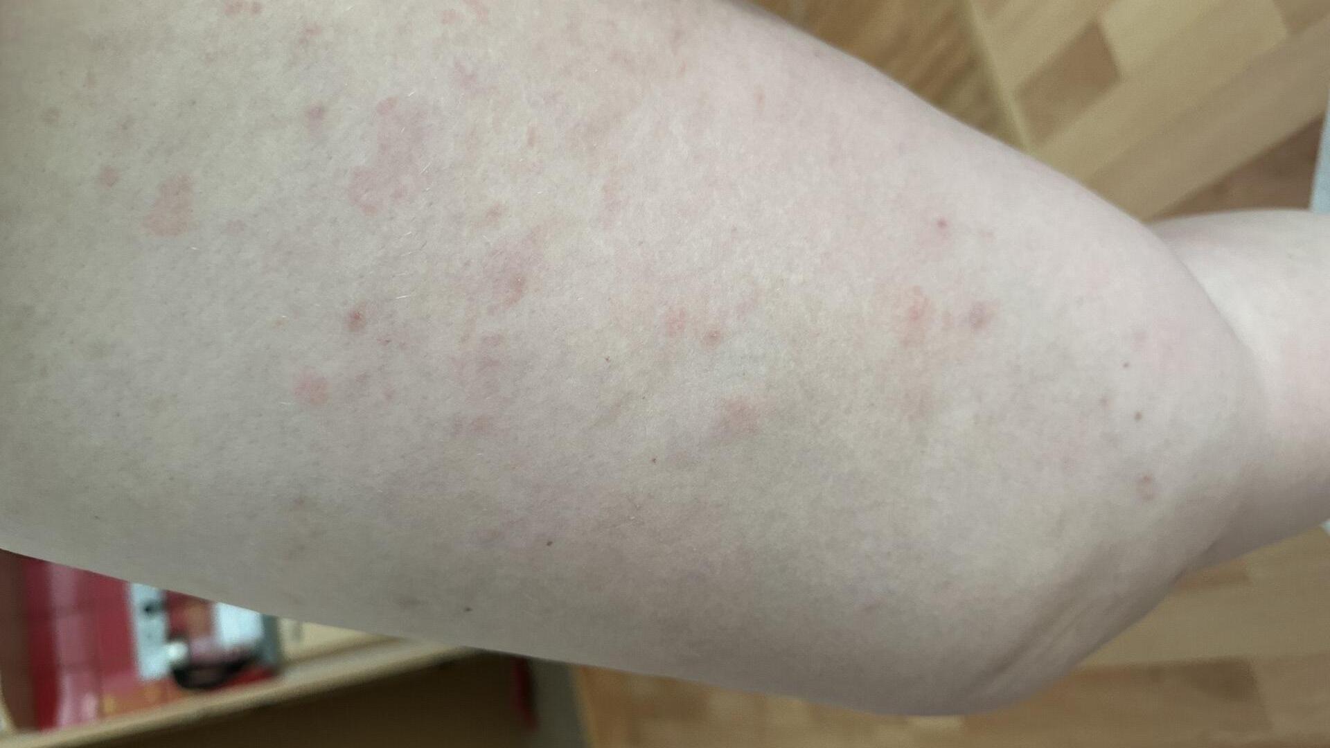 Svrab, exém nebo vyrážka? - Diskuze - eMimino.cz