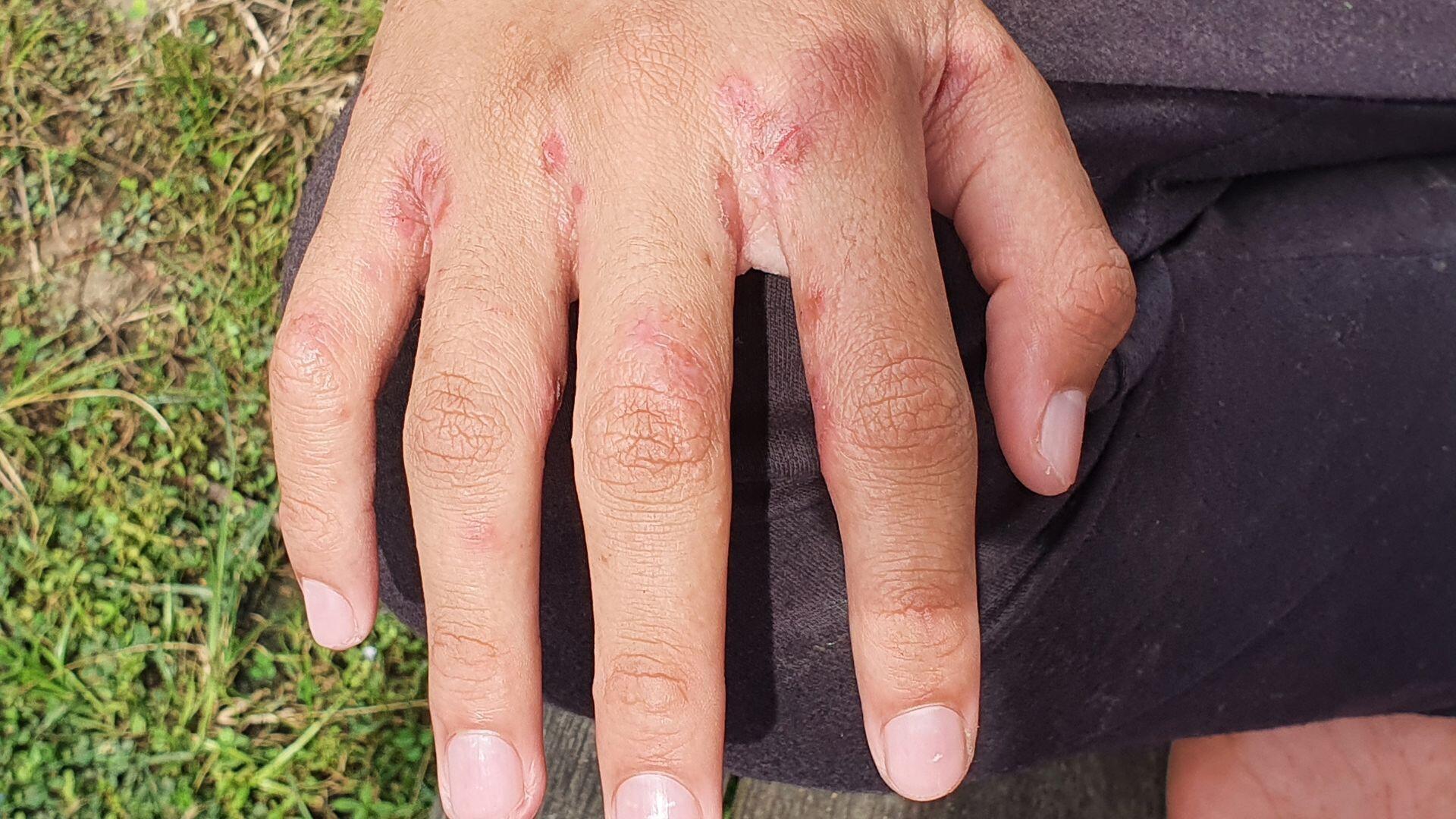 Svrab na vzestupu: Itálie hlásí 750% nárůst, jak se tomu vyhnout na ...