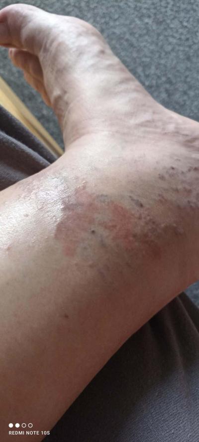 Flaxios místo Detralexu? Měl jste někdo? Je stejně účinný? - Diskuze ...